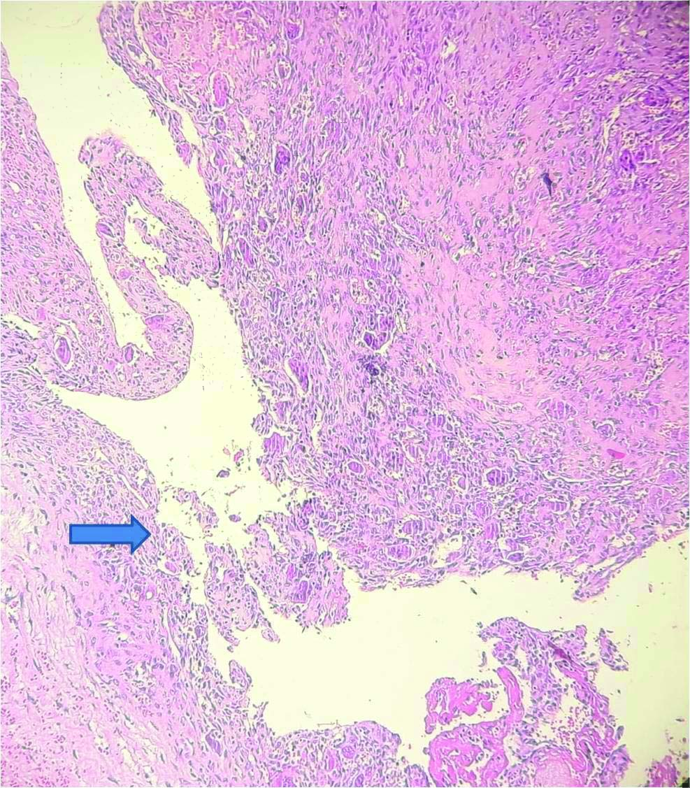 Microphotograph showing a cellular lesion with vascular space (arrow ...