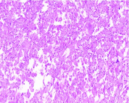 Individual cells showing abundant eosinophilic granular cytoplasm and ...