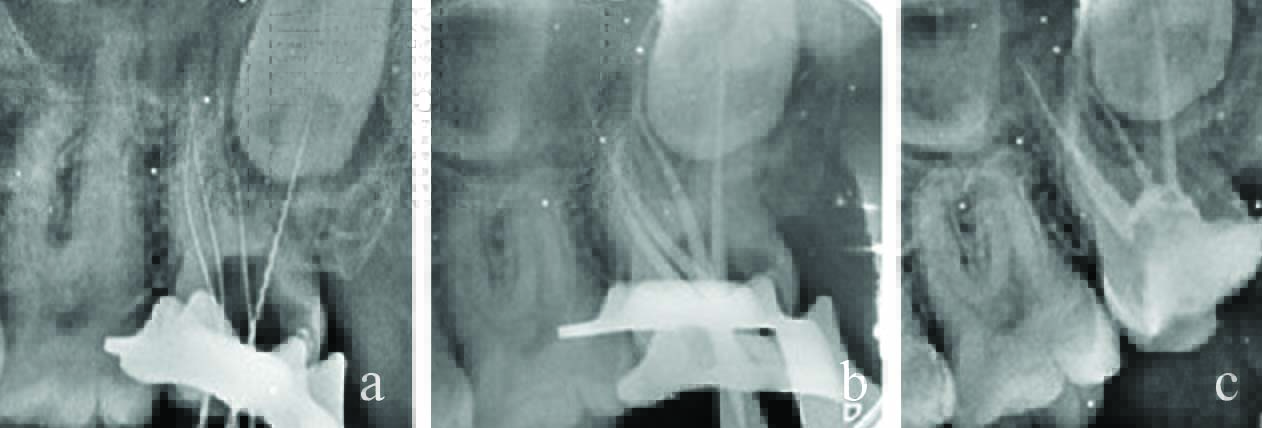 a-c) Radiograph showing working length of all four roots #27, Master ...
