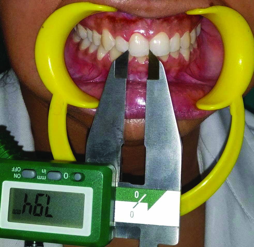 Digital vernier calliper being held parallel to the occlusal plane and ...