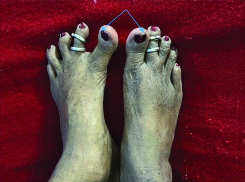 Ventral view of hallus valgus deformity of left foot.