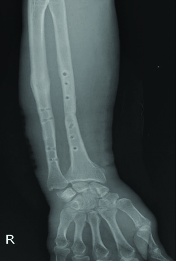X-ray immediately after implant removal showing screw holes.