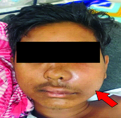 Diffuse swelling over left malar region in a 15-year-old male.