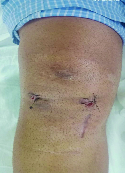 Coronal view of the septic knee.