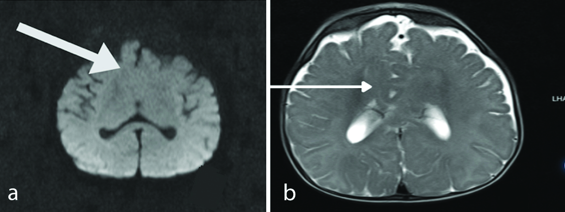 a) The anteroinferior portion of the frontal lobe is fused in the ...