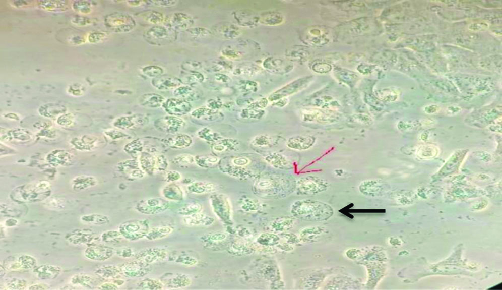 Infected A549 cell line showing clustering of cells (Grape-like ...