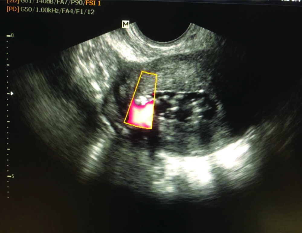 Colour doppler box with passage of air bubbles and fluid through ...