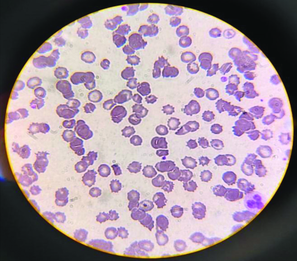 Peripheral smear showing low platelet count.