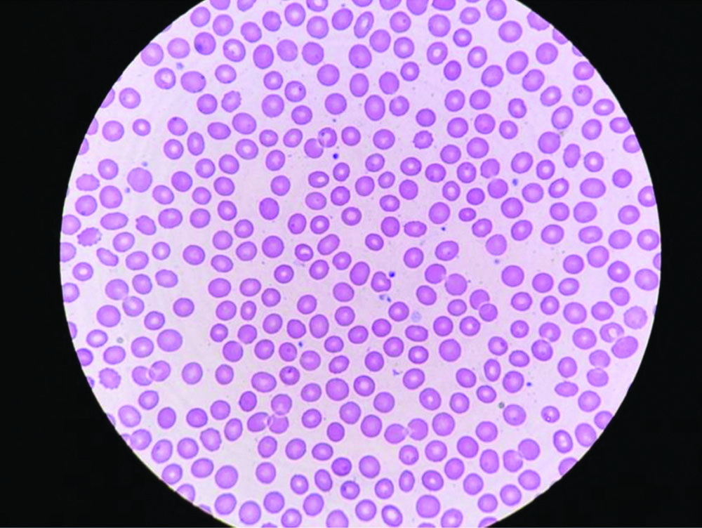 Platelet count over POD.
