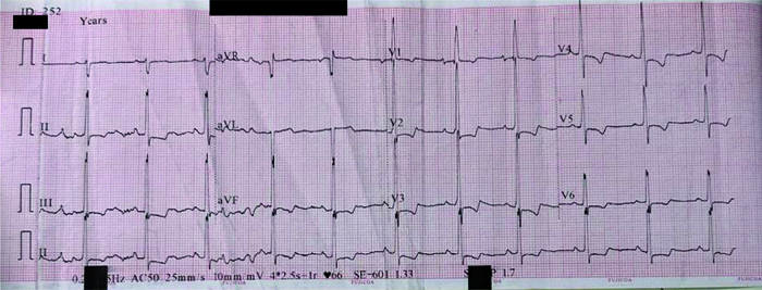 Patients ECG showing right axis deviation, right ventricular ...