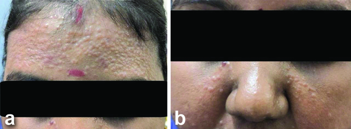 a,b) Showing multiple skin coloured, smooth, papules over the forehead ...