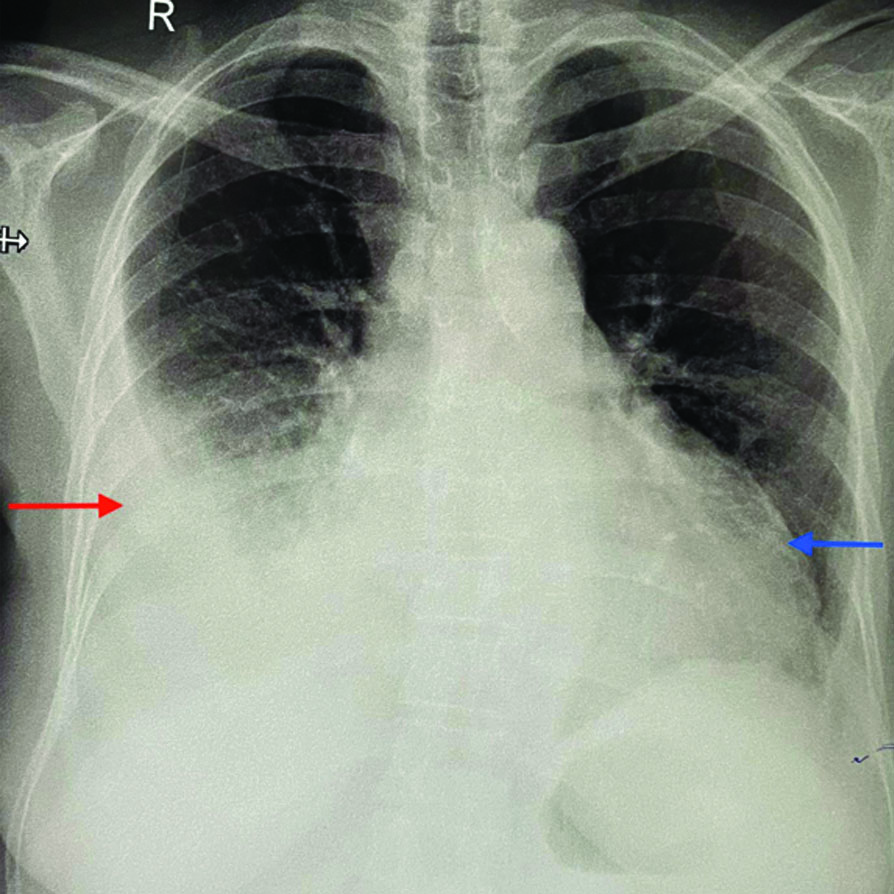 A 2D-Echocardiography showing dilated LA/LV/RA/RV.