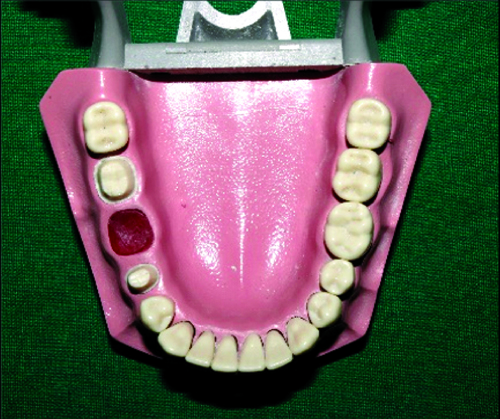 Typodont-tooth preparation.