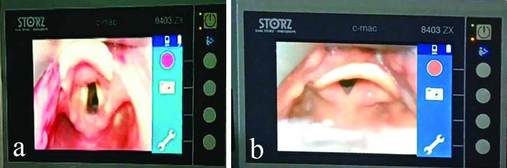 (a) Full glottis view and; (b) Restricted glottis view with C-MAC D blade.
