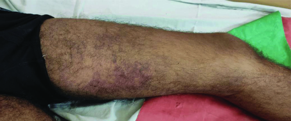 Postoperative bruising in control group.
