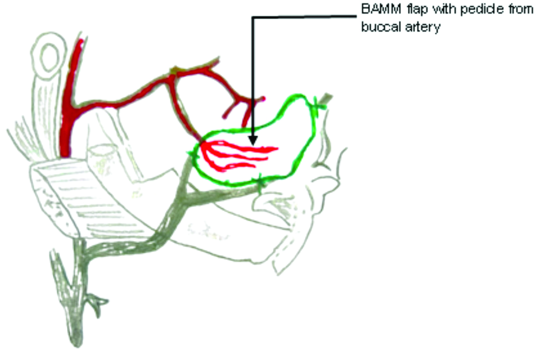 Buccinator myomucosal flap (Green outline shows the boundaries of flap ...