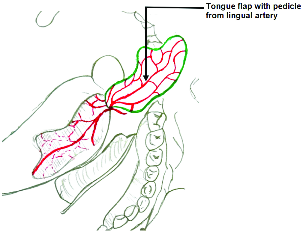 Tongue flap (Green outline shows the boundaries of flap with the ...