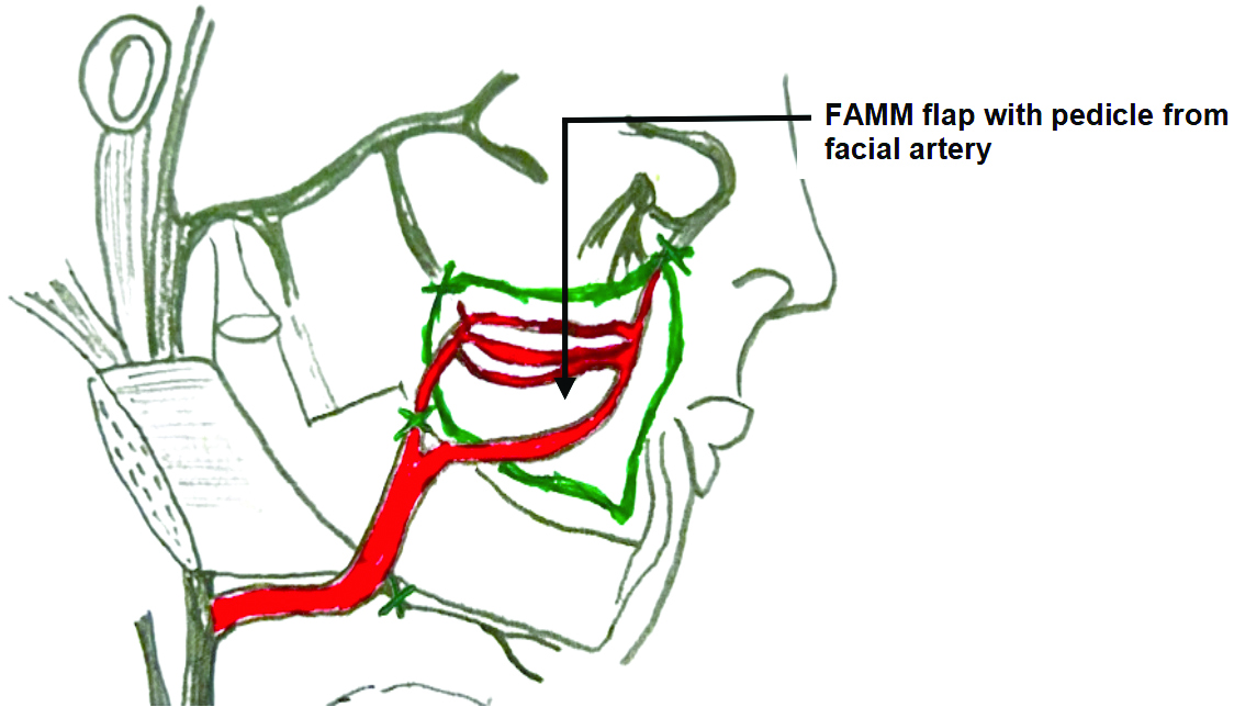 Facial artery myomucosal flap (Green outline shows the boundaries of ...