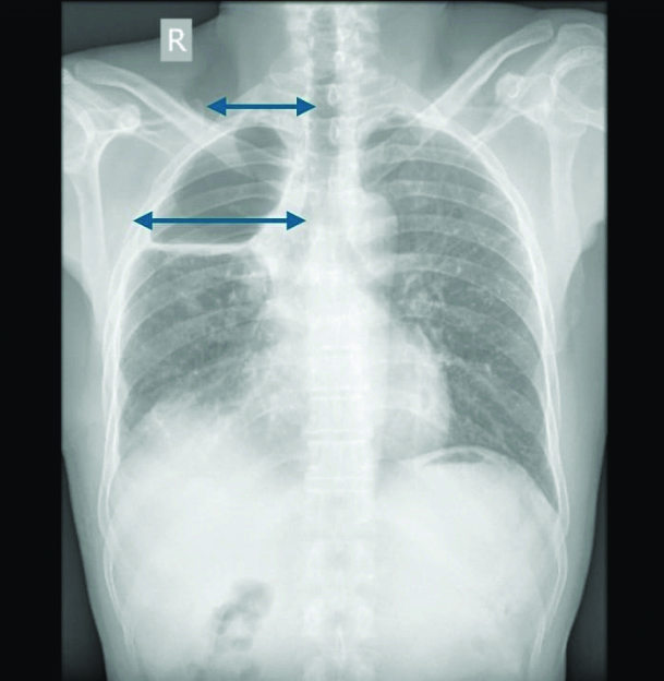 The surgical procedure performed included a right upper and middle ...