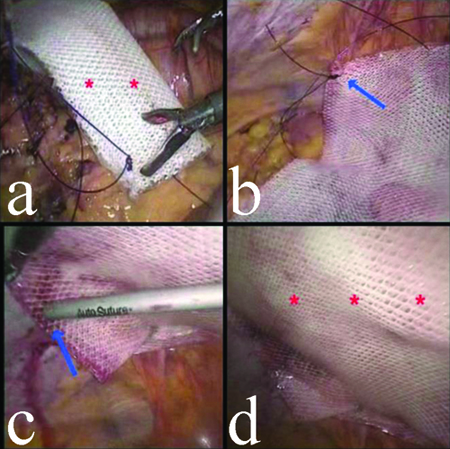 a) Rolled dual mesh (red asterisks) inserted into the abdomen; b) The ...