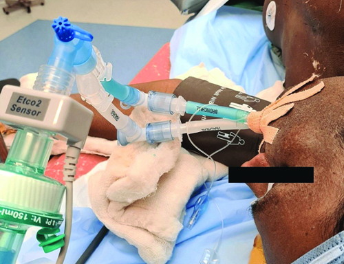 Image showing 39 no. Double Lumen Tube (DLT) and left lateral position ...
