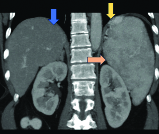 CECT abdomen coronal section- The blue arrow highlights a smooth liver ...