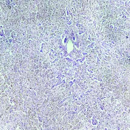 Histopathological picture of liver shows focal necrosis hepatocytes ...