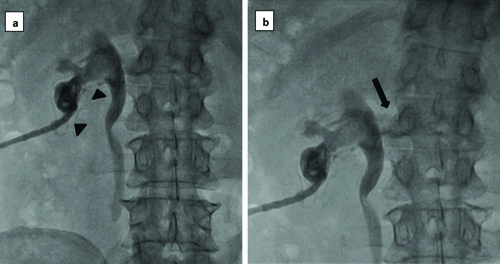 Nephrostogram via left PCN catheter showing: a) opacification of small ...