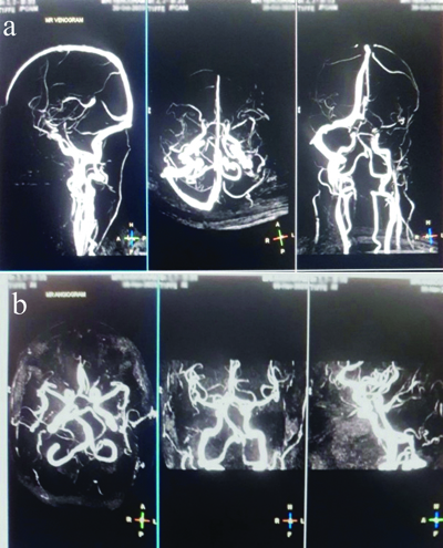 Normal appearing MR Venogram (4a) and MR Angiogram (4b) of brain with ...