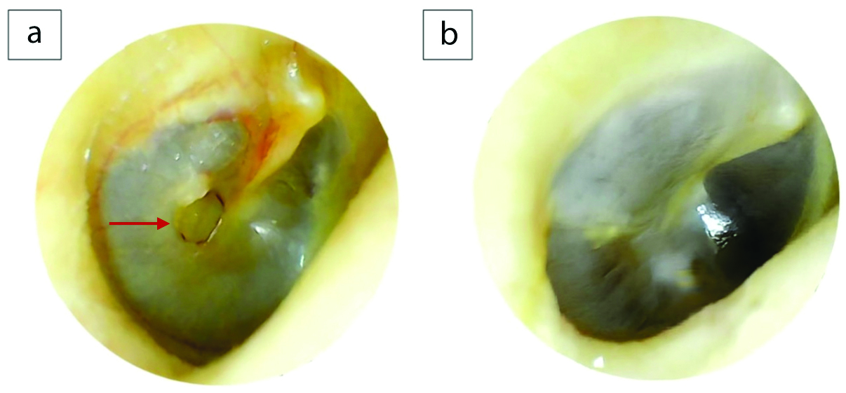 a) Small traumatic perforation (red arrow) in the pars tensa of the ...