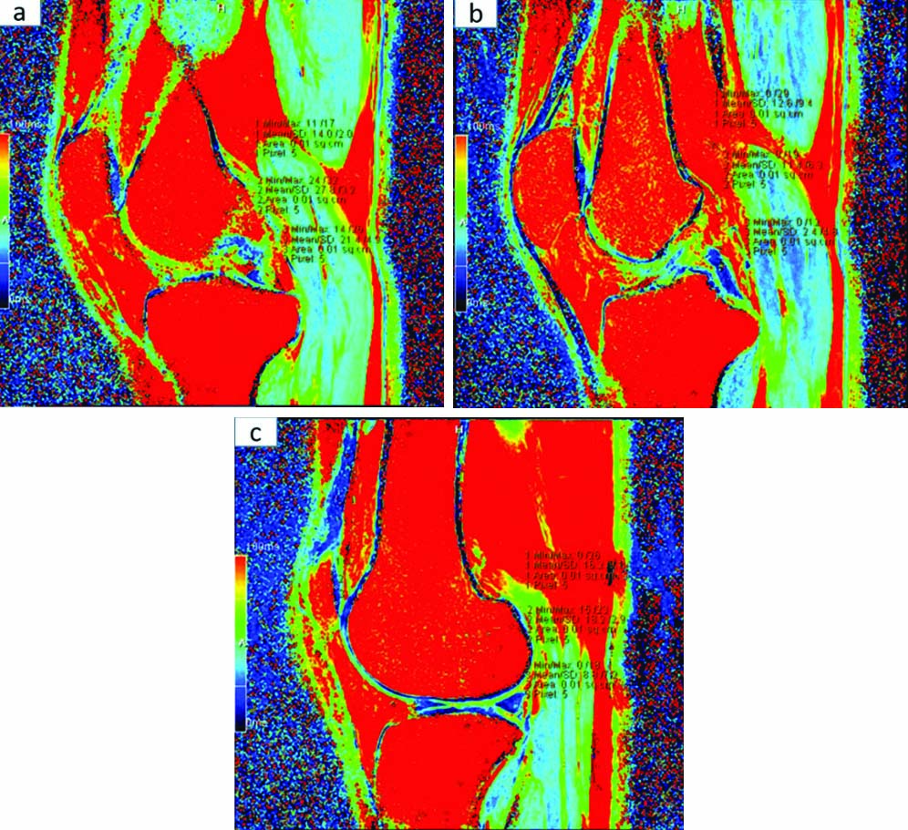 Fusion image of the medial (a) Central; (b) Lateral; (c) Patella to ...