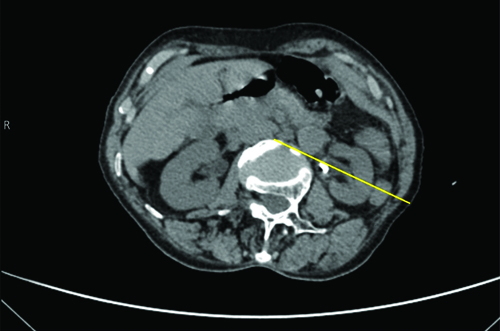 Axial images of CT scan showing part of descending colon lying ...