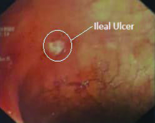 Gastric ulcer seen in upper GI endoscopy.
