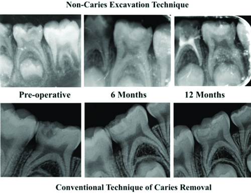 Follow-up radiographs of Non-Caries Excavation (NCE) and Conventional ...