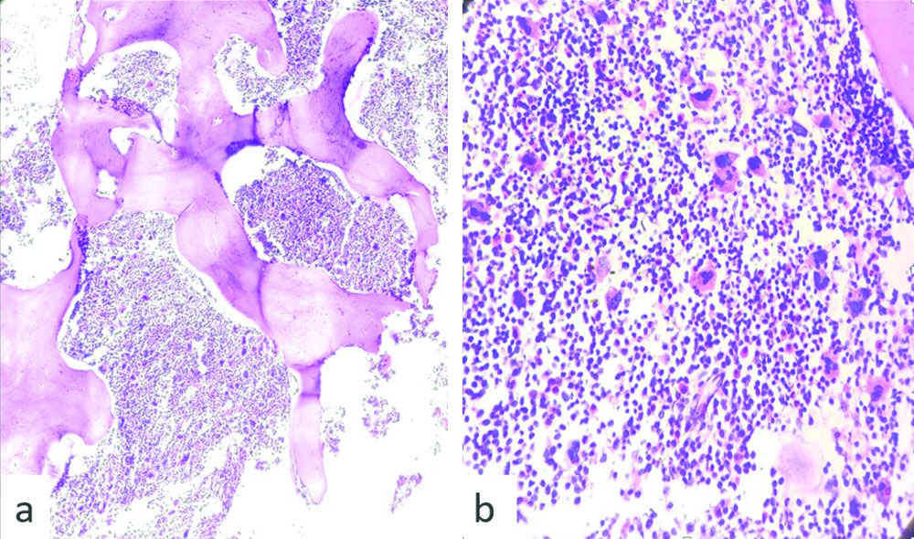 Essential Thrombocythemia (ET)- Normocellular marrow with large and ...