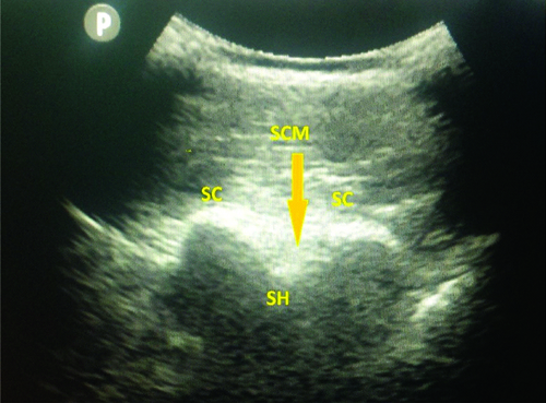 SC: Sacral cornua; SCM: Sacro-coccygeal membrane; SH: Sacral hiatus