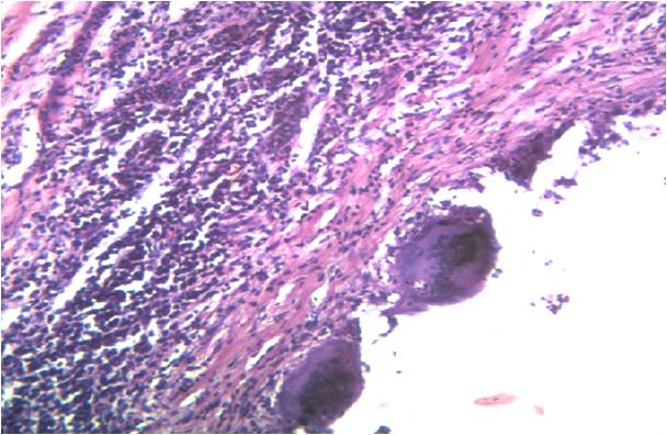 In view of the histological diagnosis of cysticercus, an extensive ...