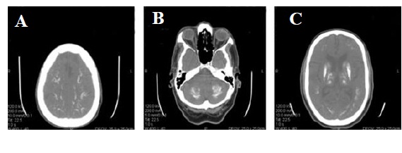 Dentate Nucleus Calcification