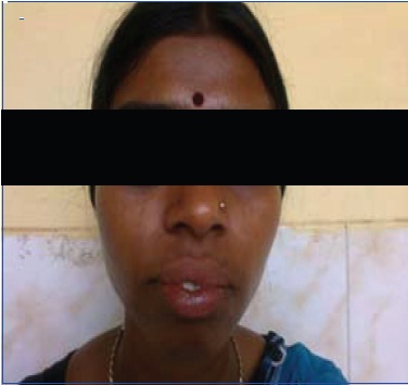 Clinical picture of the 23-year-old female patient with proptosis of ...