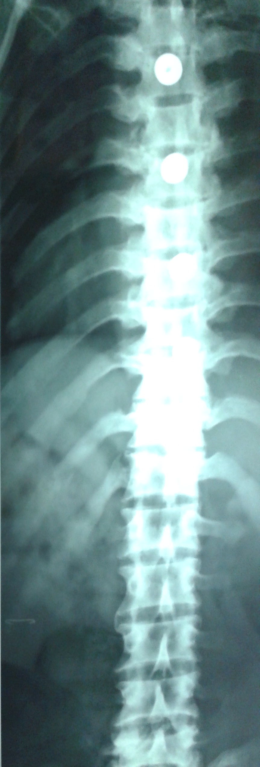 X-ray pelvis AP view showing triradiate pelvis with bilateral protrusio ...