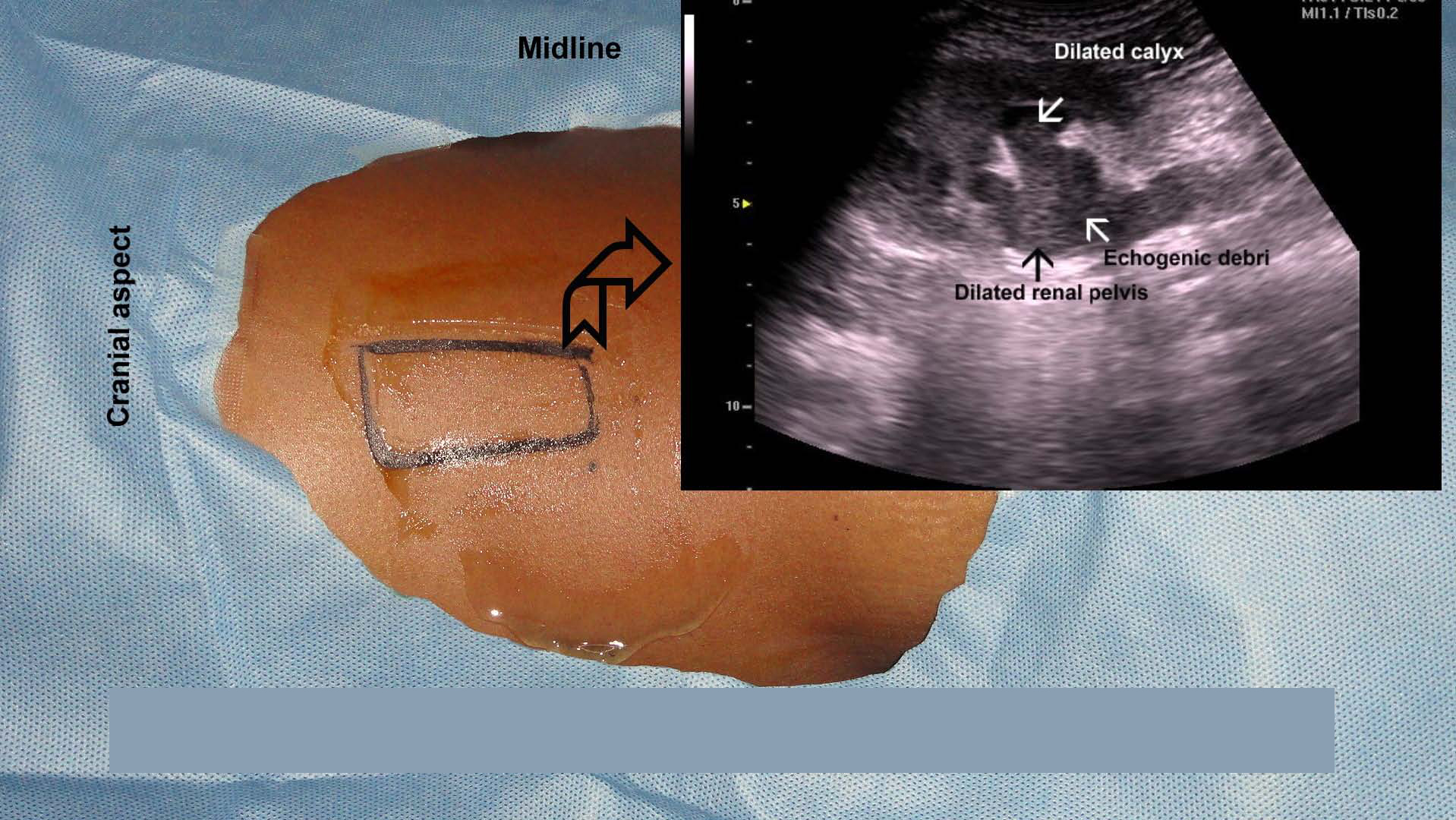 Nephrostomy Tube Ultrasound