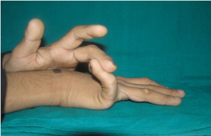 Hypermobility of little finger - positive
