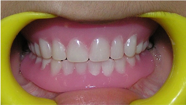 Classification of EDS Types