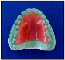 Intraoral view of the experimental palatal plate