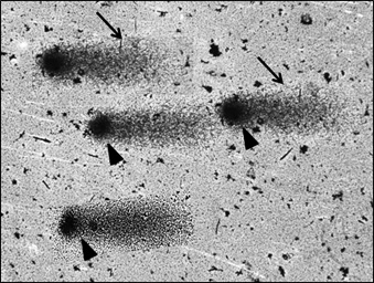 Comets – Isolated Septal Defect