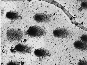 Comets – Septal Defect with Great Vessel Anomaly Black arrow heads ...