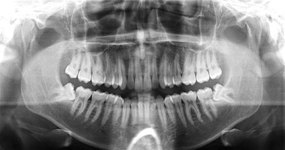 Pre-operative panoramic radiograph showing erupted 18, 28, and impacted ...