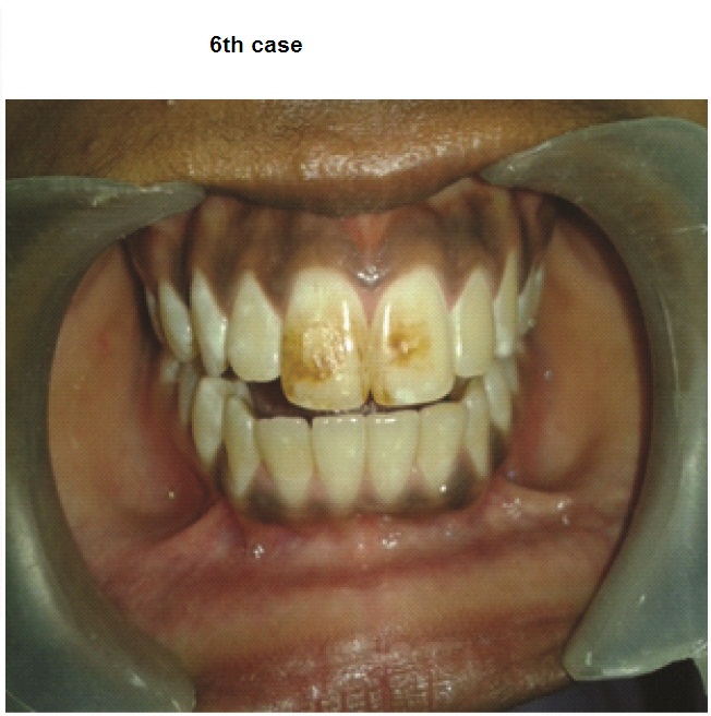 Post operative photograph of case 6