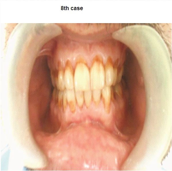 Post operative photograph of case 8