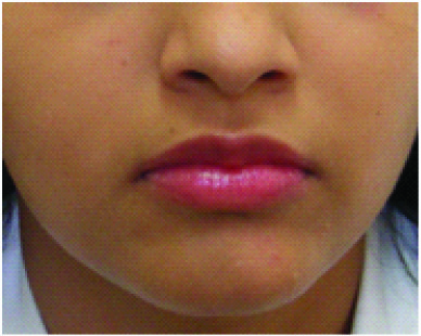 Expand the smile slightly to expose the edges of the teeth